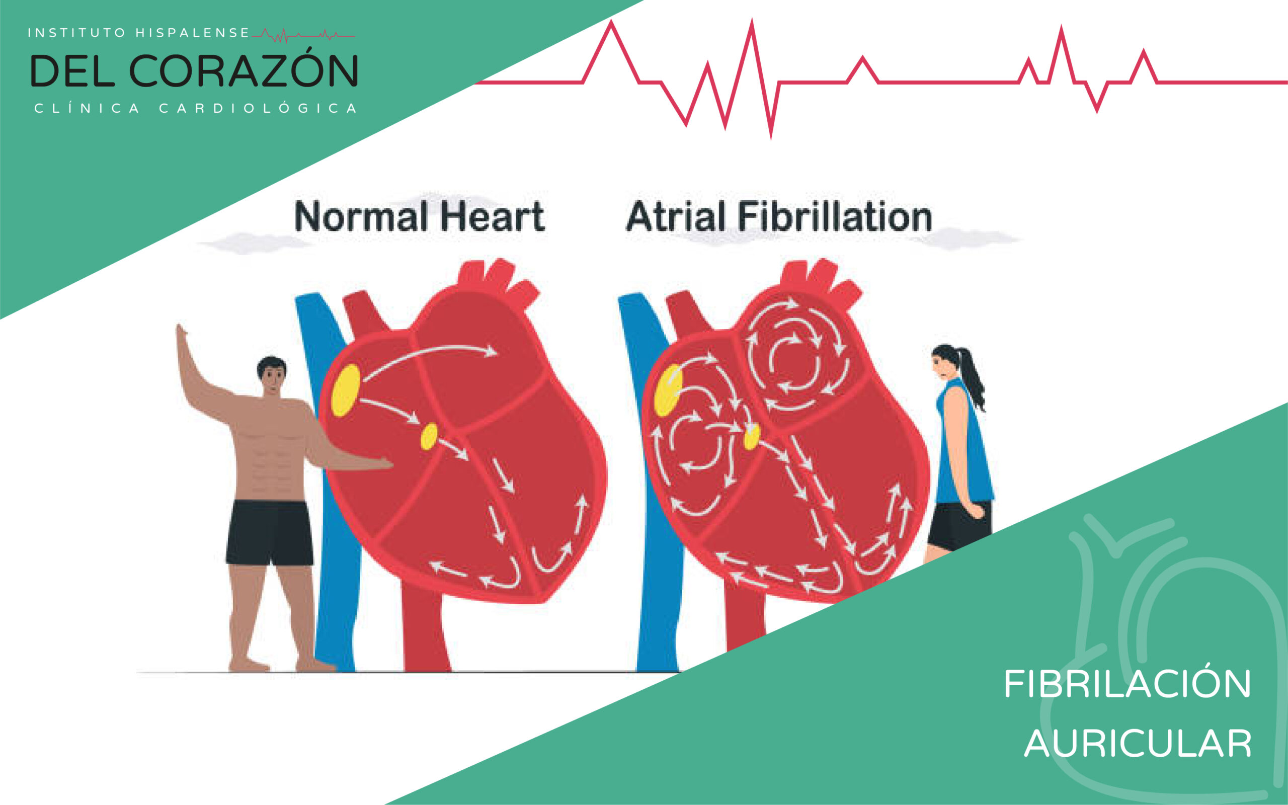 Fibrilación Auricular - Instituto Hispalense del Corazón